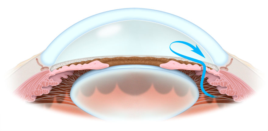 Tipos de Glaucomas (II): Glaucoma de ángulo estrecho - Blog de Ojos ...